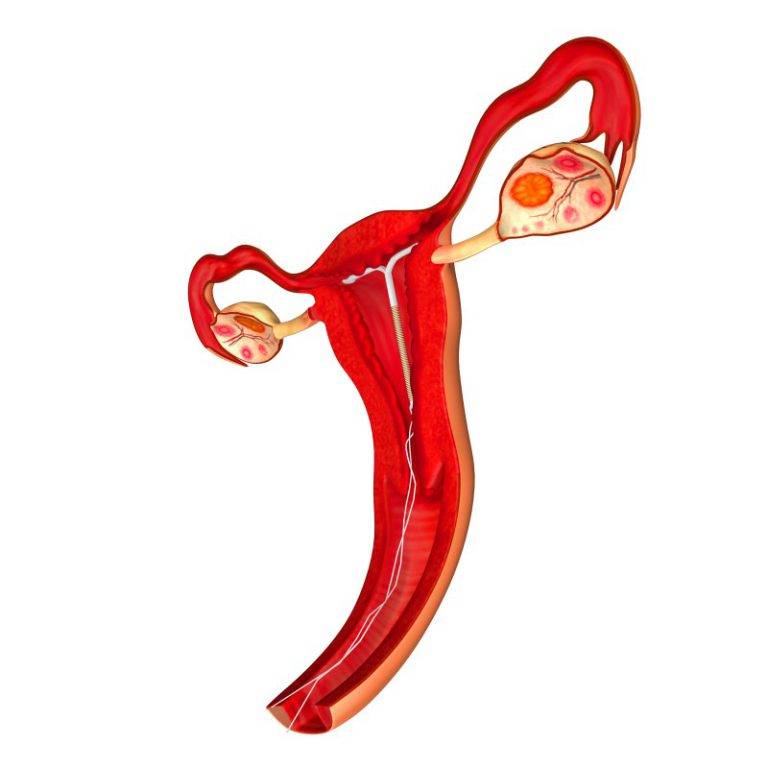 Jangan Bilang Sudah Tahu Tentang IUD Sebelum Baca Ini – DP3APPKB Kota ...